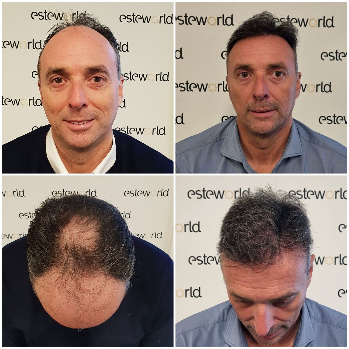 Marco van Dam straalt na zijn haartransplantatie